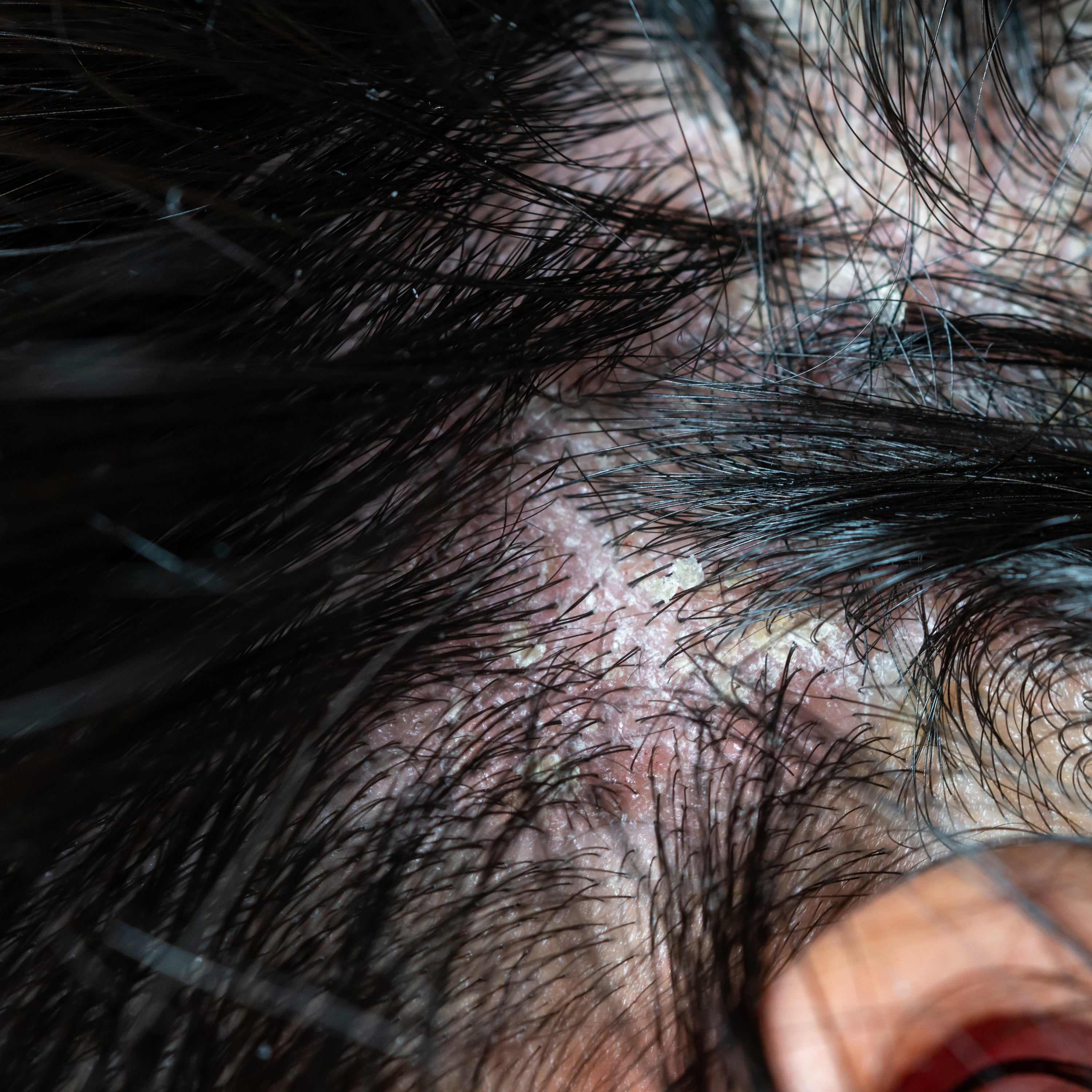 The Psoriasis Area and Severity Index - Polytar